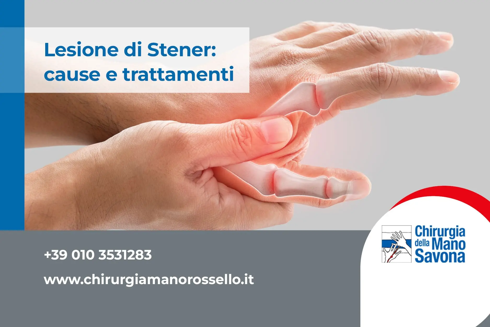 Lesione di Stener: cause e trattamenti - Chirurgia della mano Mario ...
